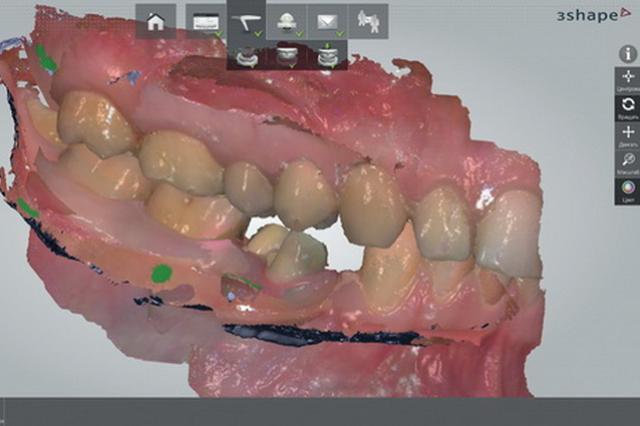 Model Builder от 3Shape – простой путь от цифрового слепка до разборной ...