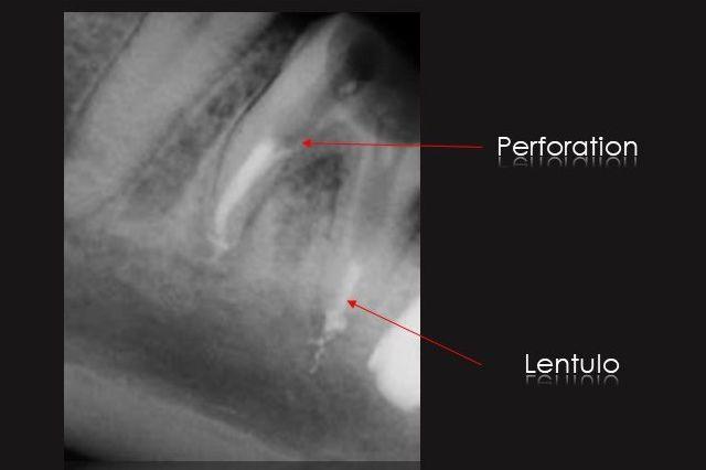 Сложное эндо: воспалительный процесс, вызванный выведенным отломком ...